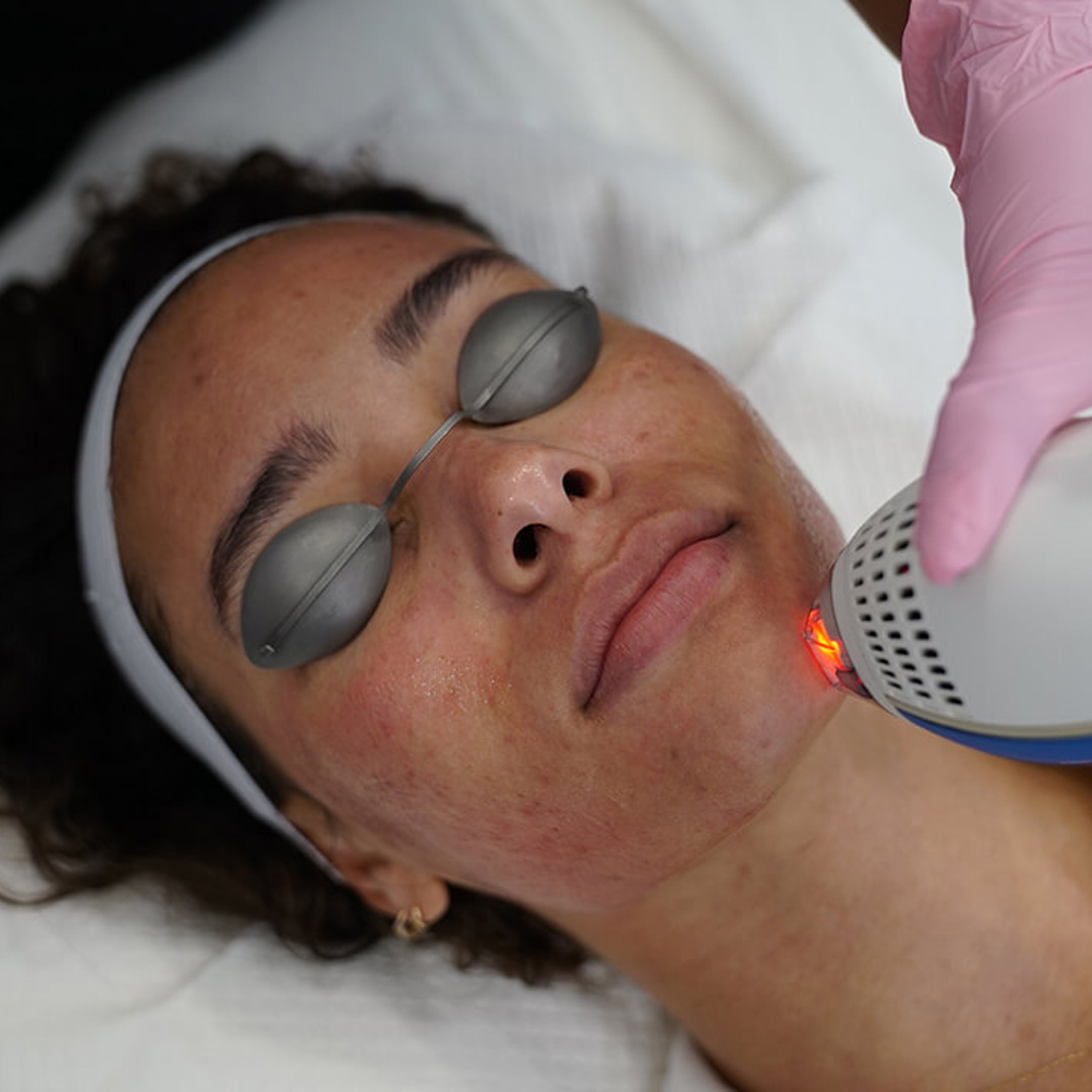 Acne Solution – Korean Skin and Health Care